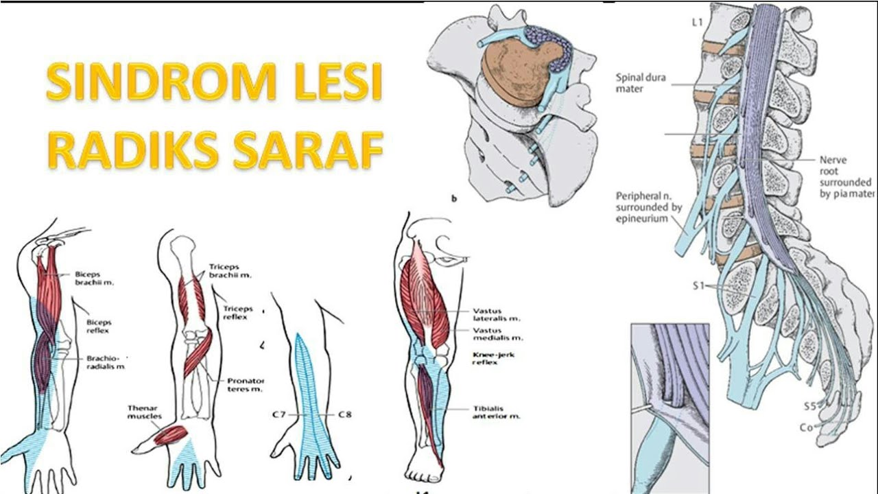 Video 21 Sindrom Lesi Radiks Saraf - YouTube