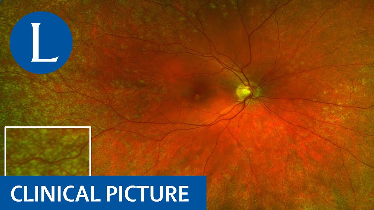 Drusen in the retina - YouTube