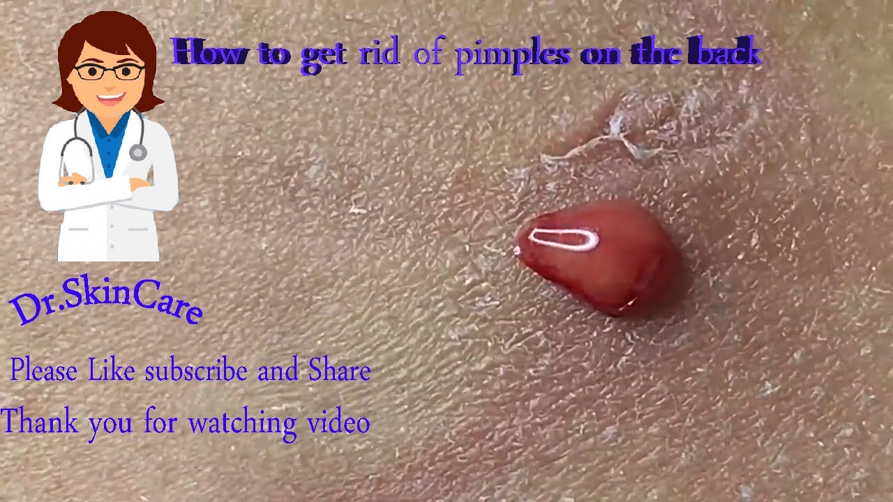 How to get rid of pimples on the back - Dr skincare# 8 - YouTube