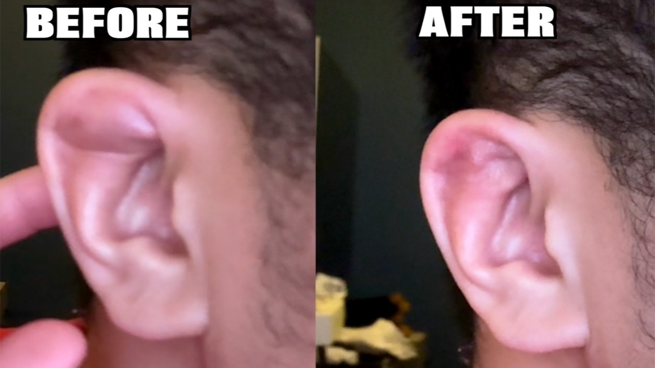 How to Drain Cauliflower Ear - YouTube