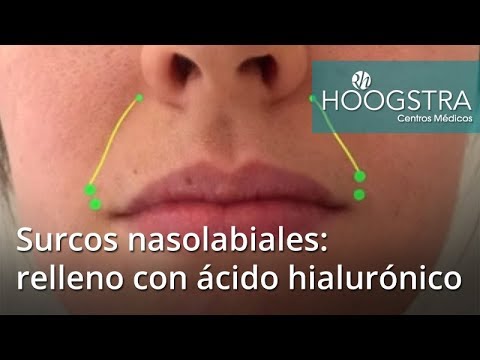 Surcos nasolabiales: relleno con ácido hialurónico (20014) - YouTube