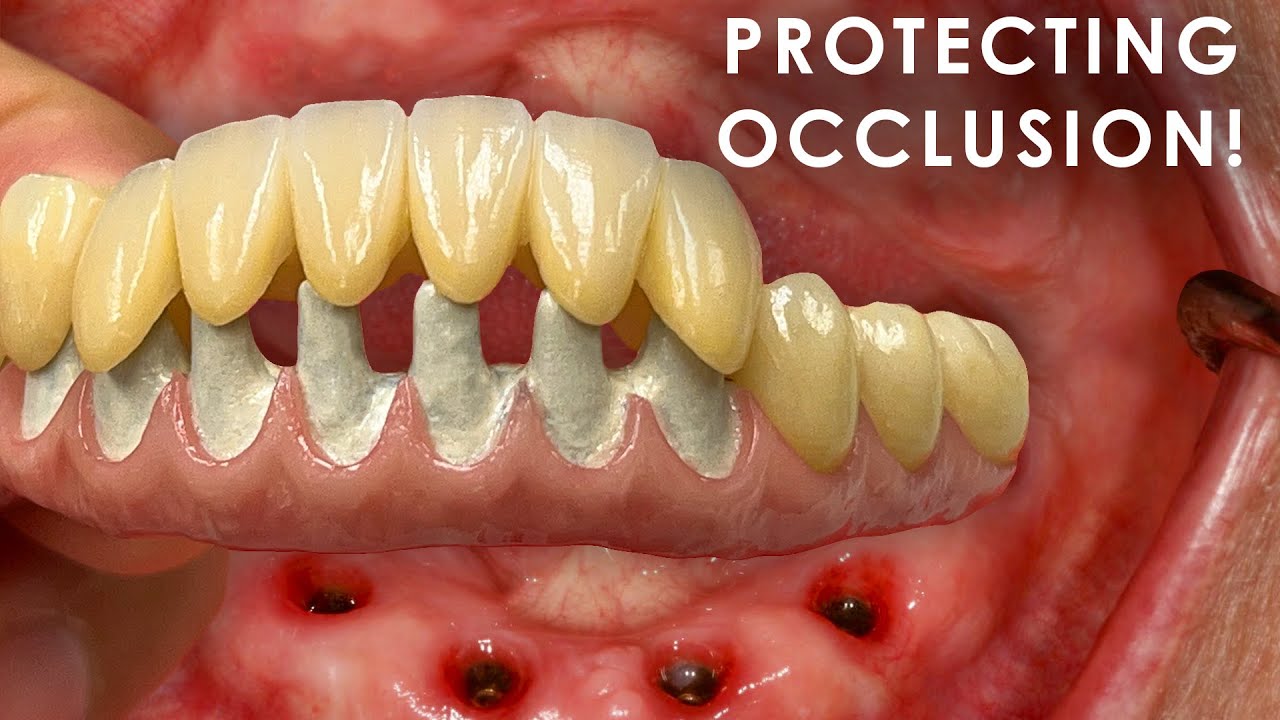 Excellent Solutions for Occlusion Protection on Full Mouth Implants ...