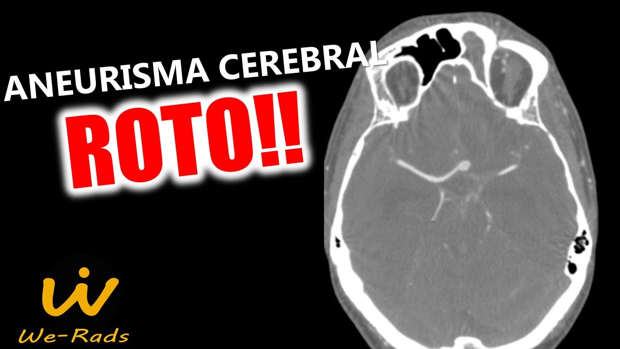 Aneurisma cerebral roto na tomografia de crânio - YouTube