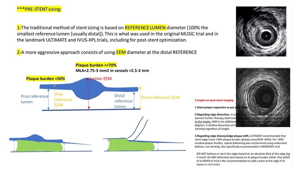 IVUS/OCT stent guidance, pre- and post-stenting - YouTube