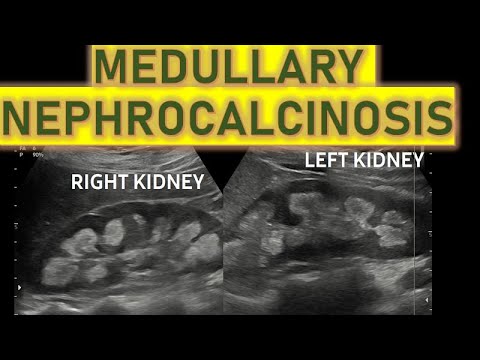 BILATERAL MEDULLARY NEPHROCALCINOSIS ON USG / And its causes - YouTube