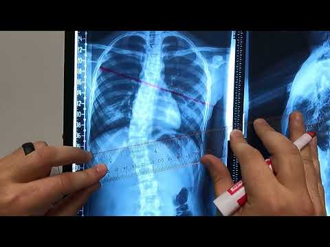 What Is The Cobb Method For Scoliosis