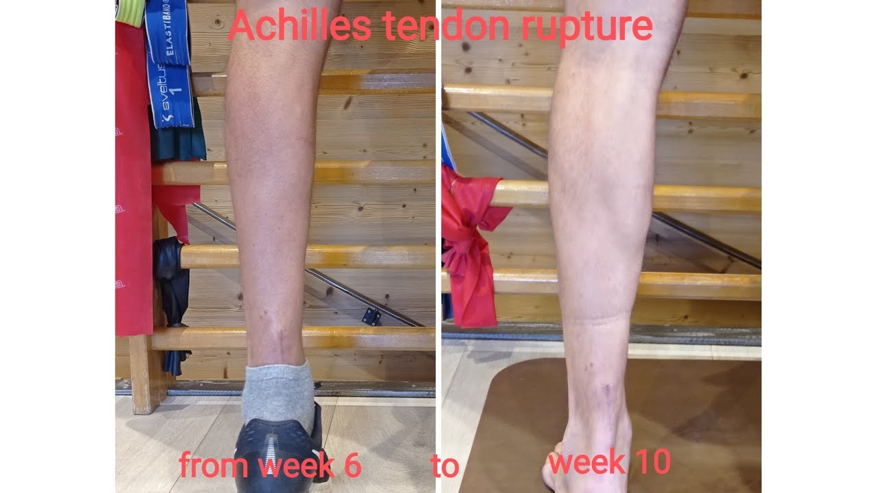 Achilles tendon rupture. 6-10 week Rehabilitation protocol ...