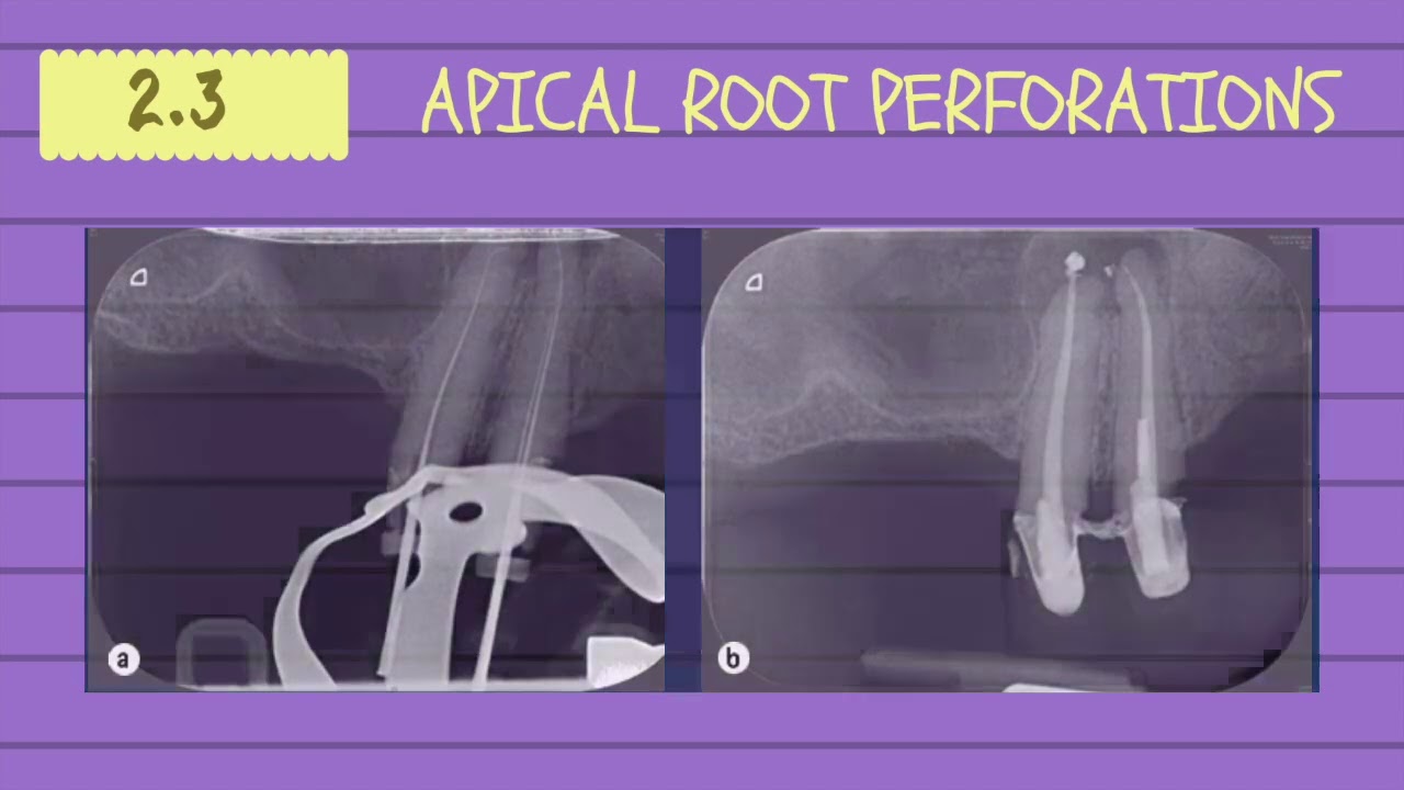 CLASSIFICATION OF PERFORATIONS IN ENDODONTICS - YouTube