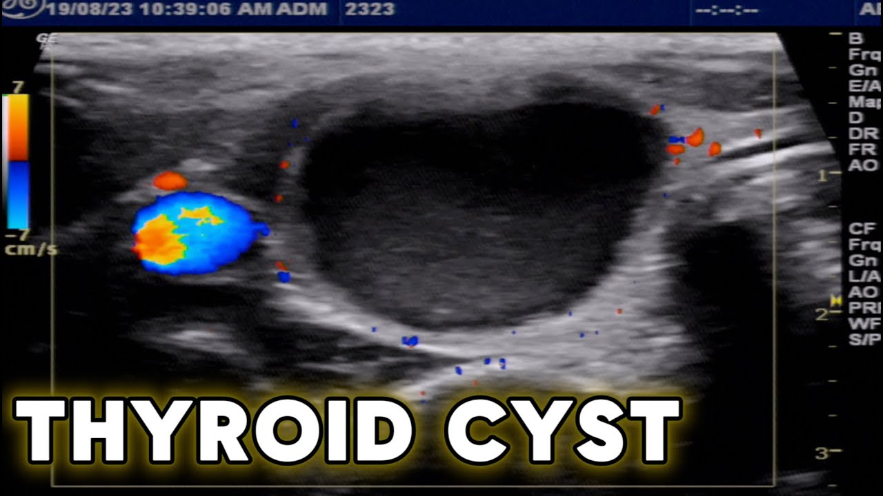 THYROID CYST | Ultrasound - YouTube
