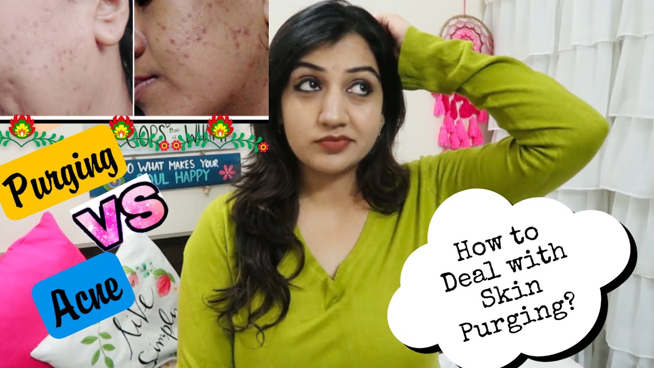 Skincare Basics - Ep-10|| Difference between Purging & Acne Breakout ...