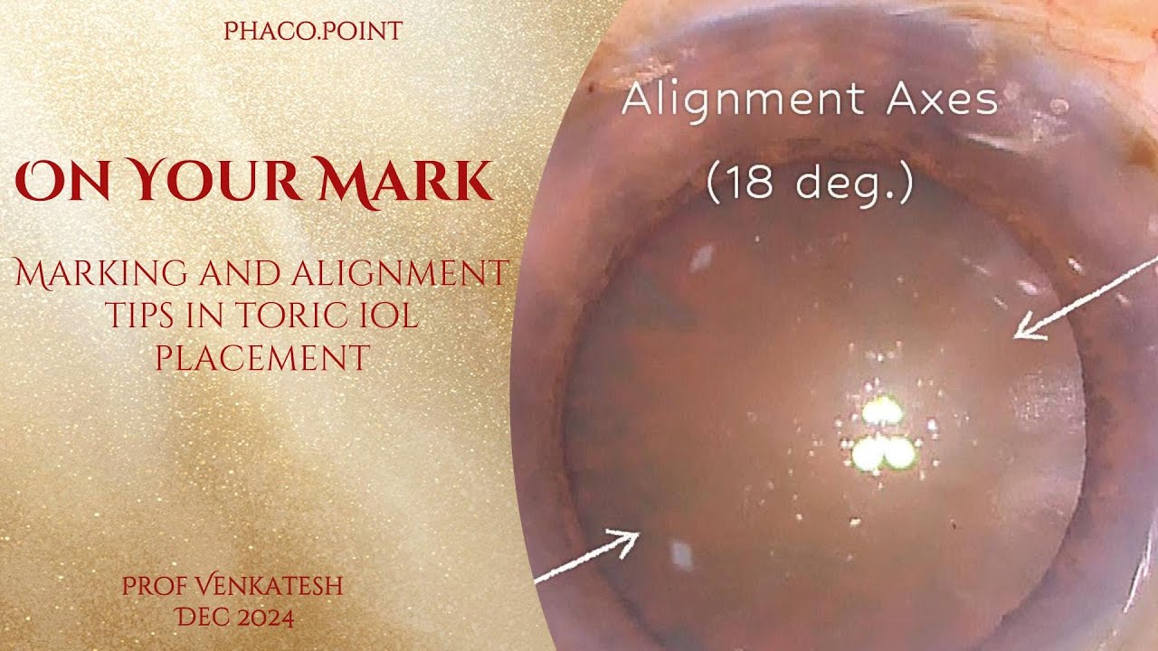 "On your mark"- Marking and Alignment Tips In Toric IOL Placement - in ...