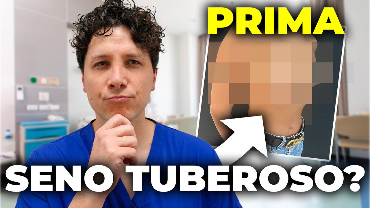 Seno Tuberoso Intervento | L'esperienza di Marina - YouTube