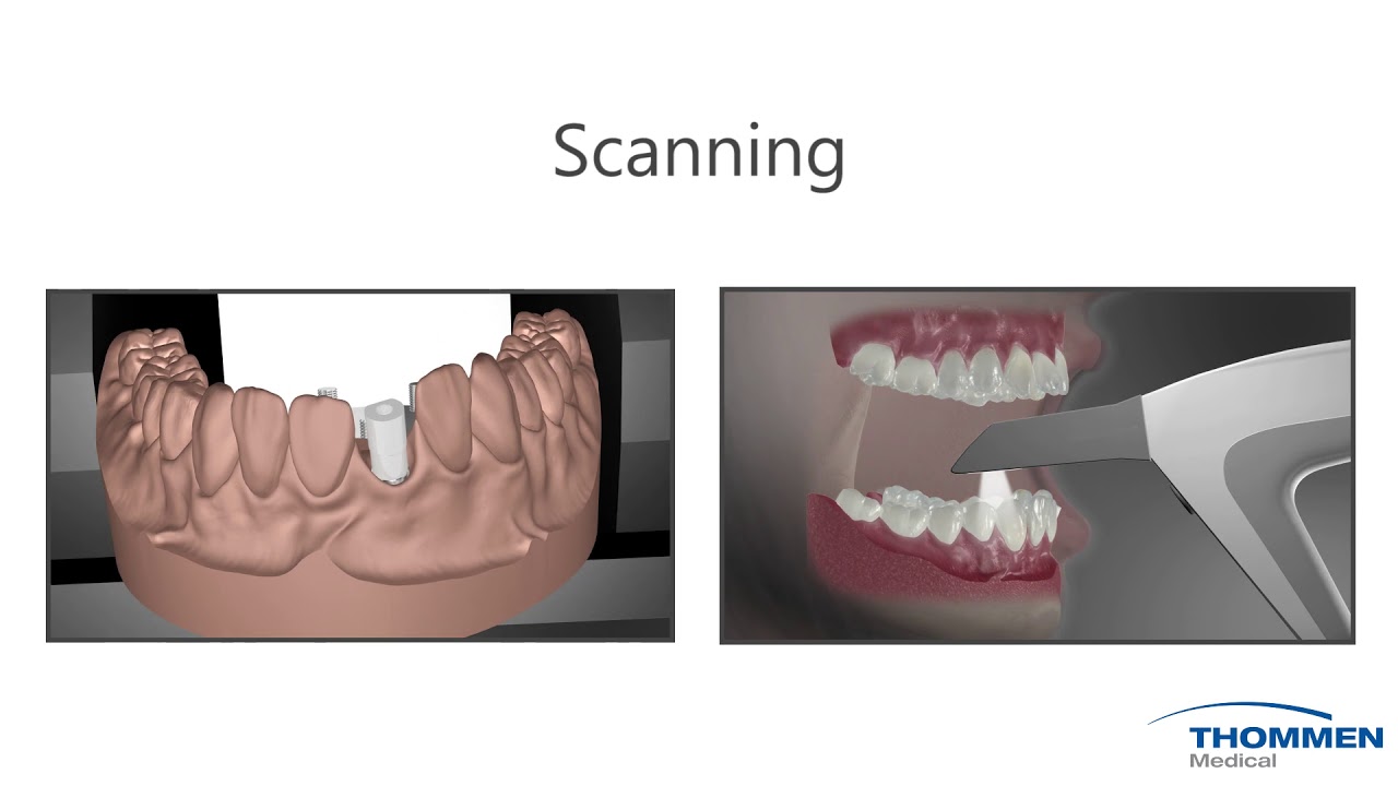 Dynamic Tibase® Thommen Medical - YouTube