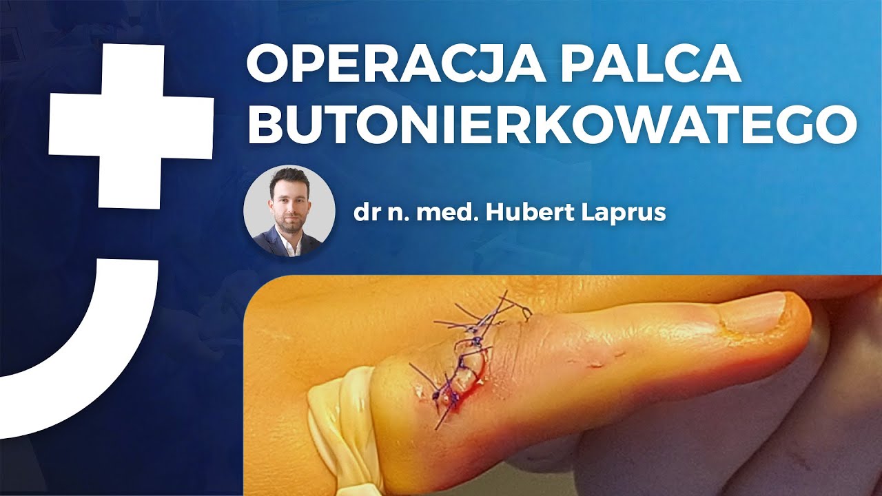 Operacja palca butonierkowatego - dr n. med. Hubert Laprus - Nowa ...