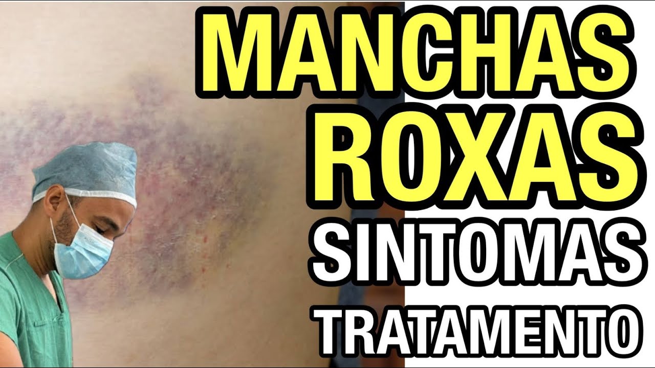 Manchas roxas no corpo: O que são? Quais as causas? Devo me preocupar ...