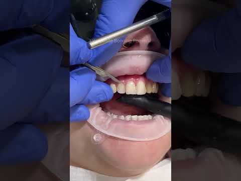 How To Remove Composite Veneers At Home