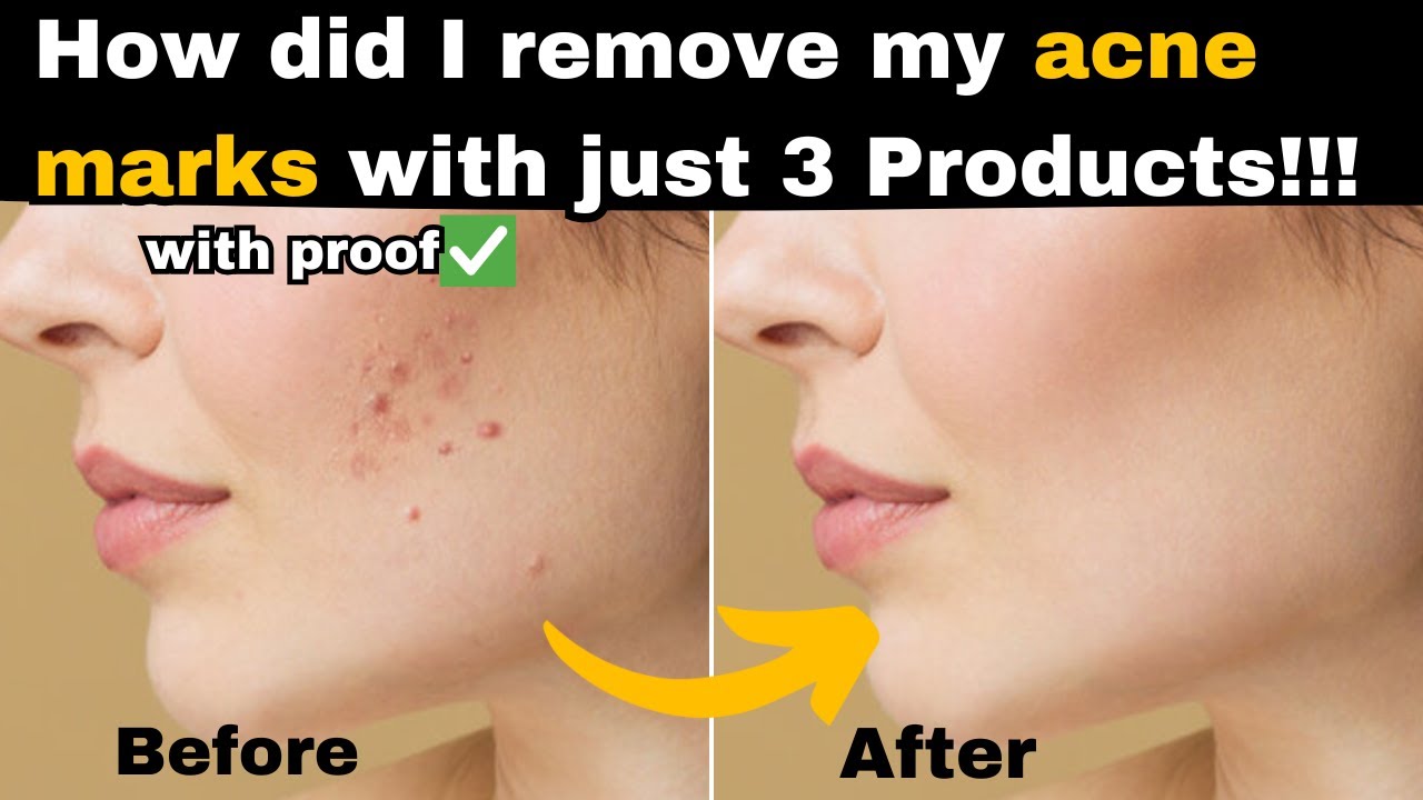 How did I remove my acne marks with just 3 products with proof| - YouTube