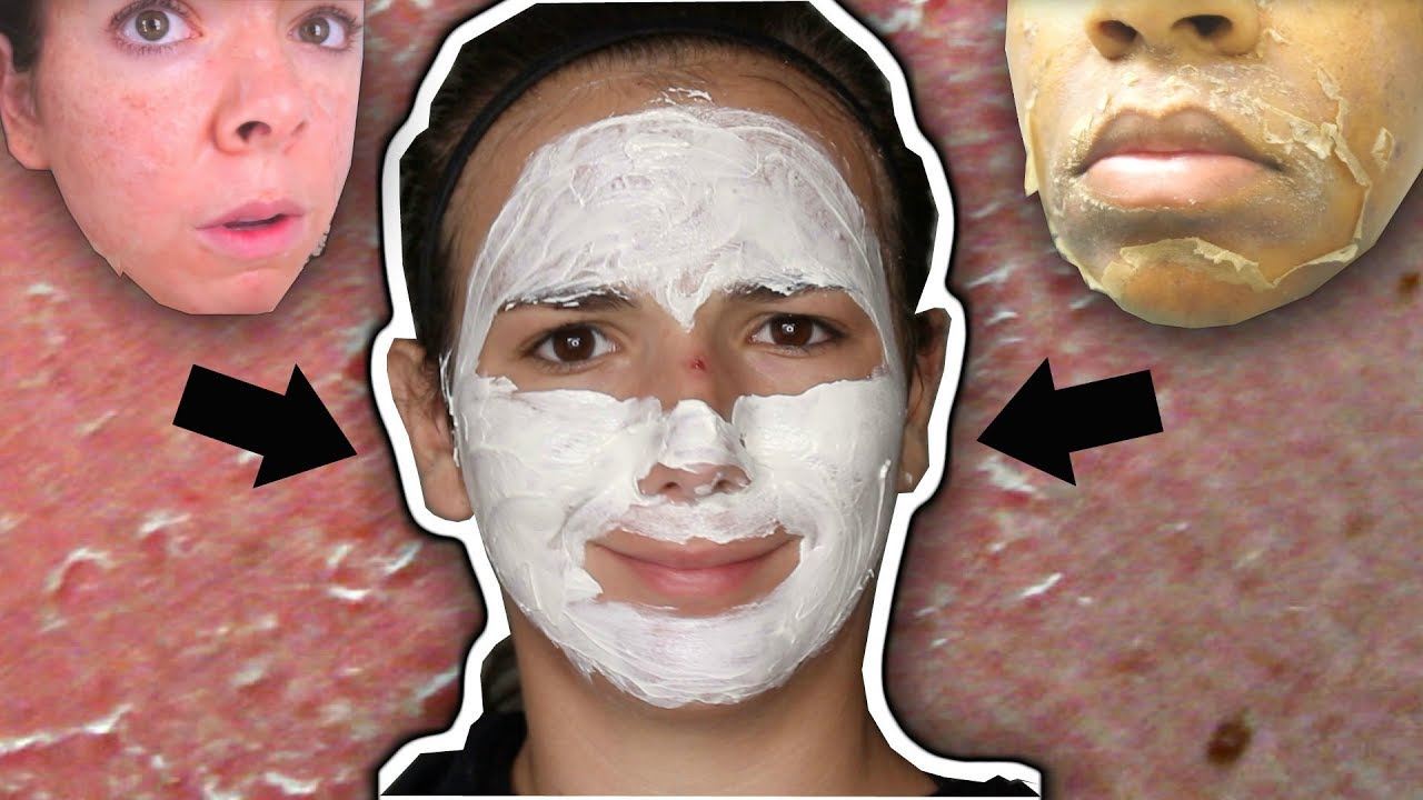 DIY CHEMICAL FACE PEEL?! *IT BURNED* - YouTube