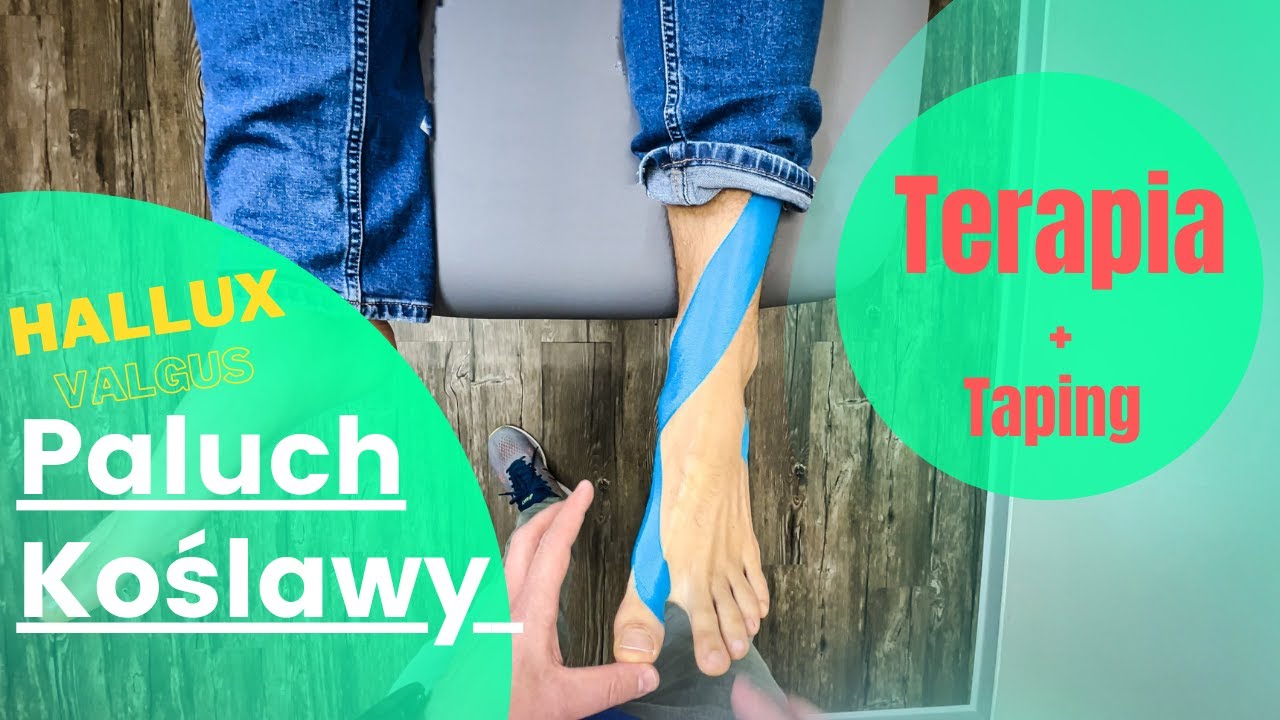 Paluch Koślawy (Hallux Valgus) - Terapia i taping #177 FizjoTerapia HD ...