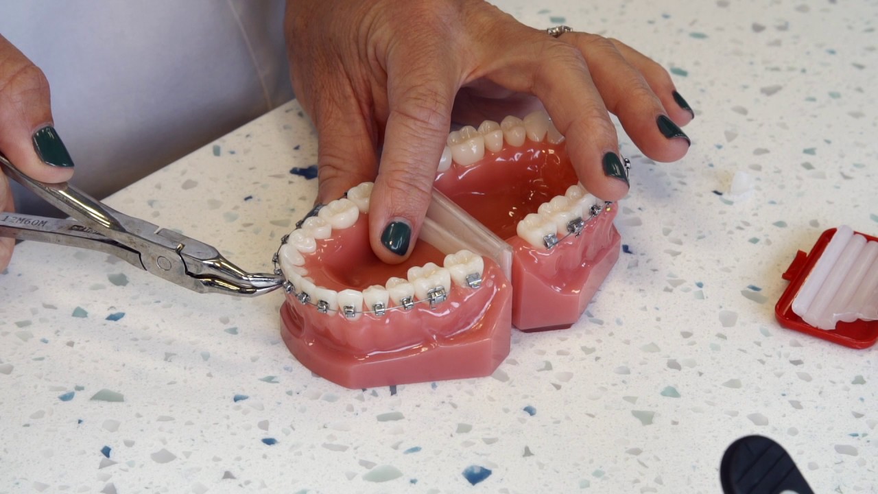 How To: Fix Pokey Orthodontic Wire At Home - YouTube