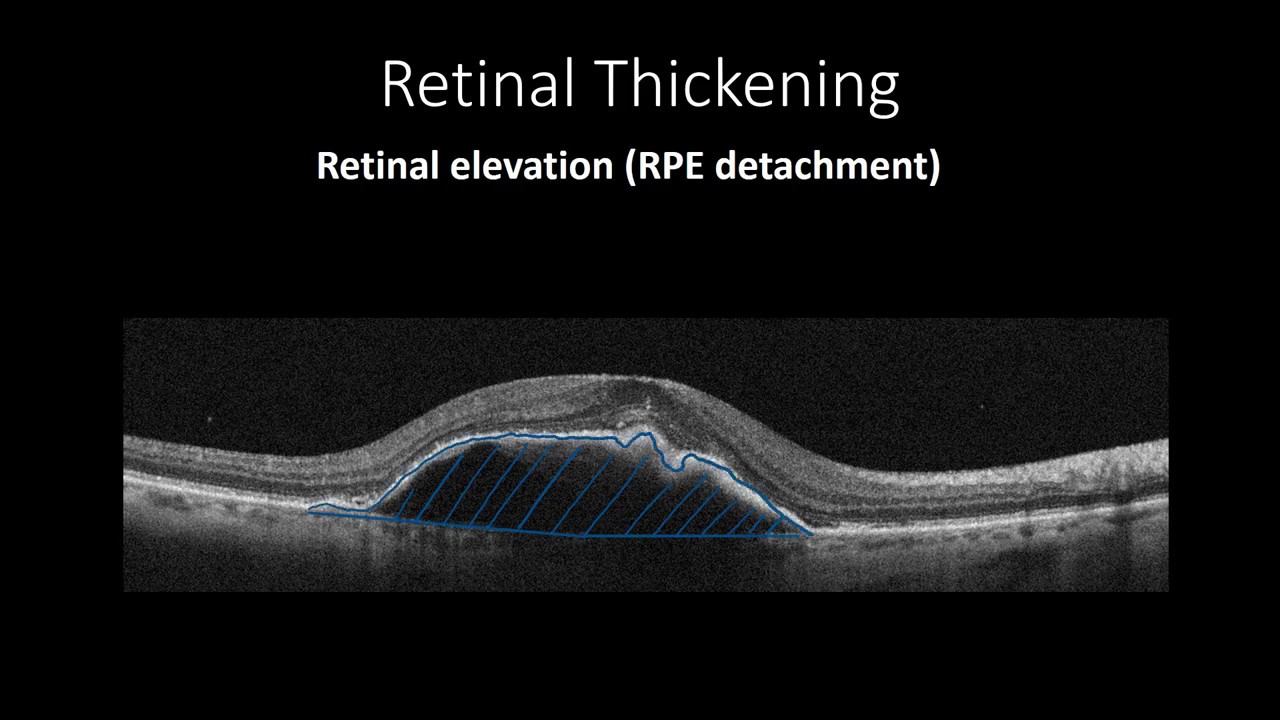 Course in clinical applications of OCT for macular diseases ...