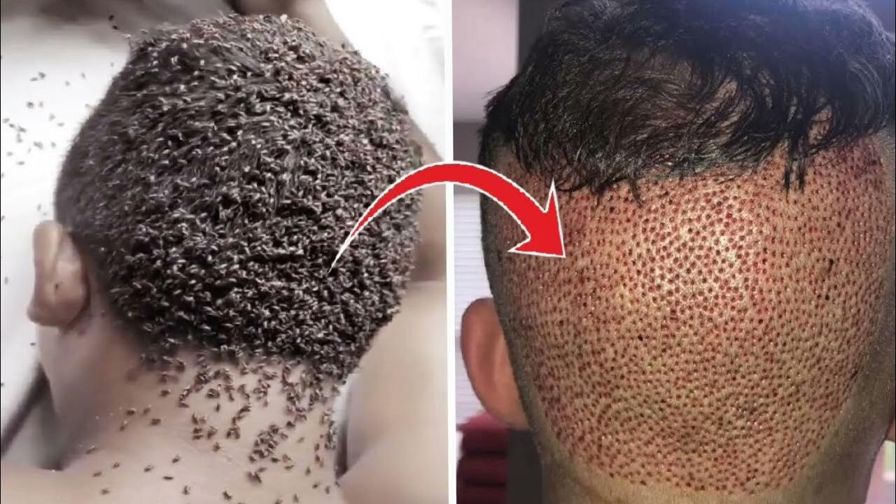KUTU RAMBUT TERBANYAK DI KEPALA MANUSIA DI DUNIA - YouTube