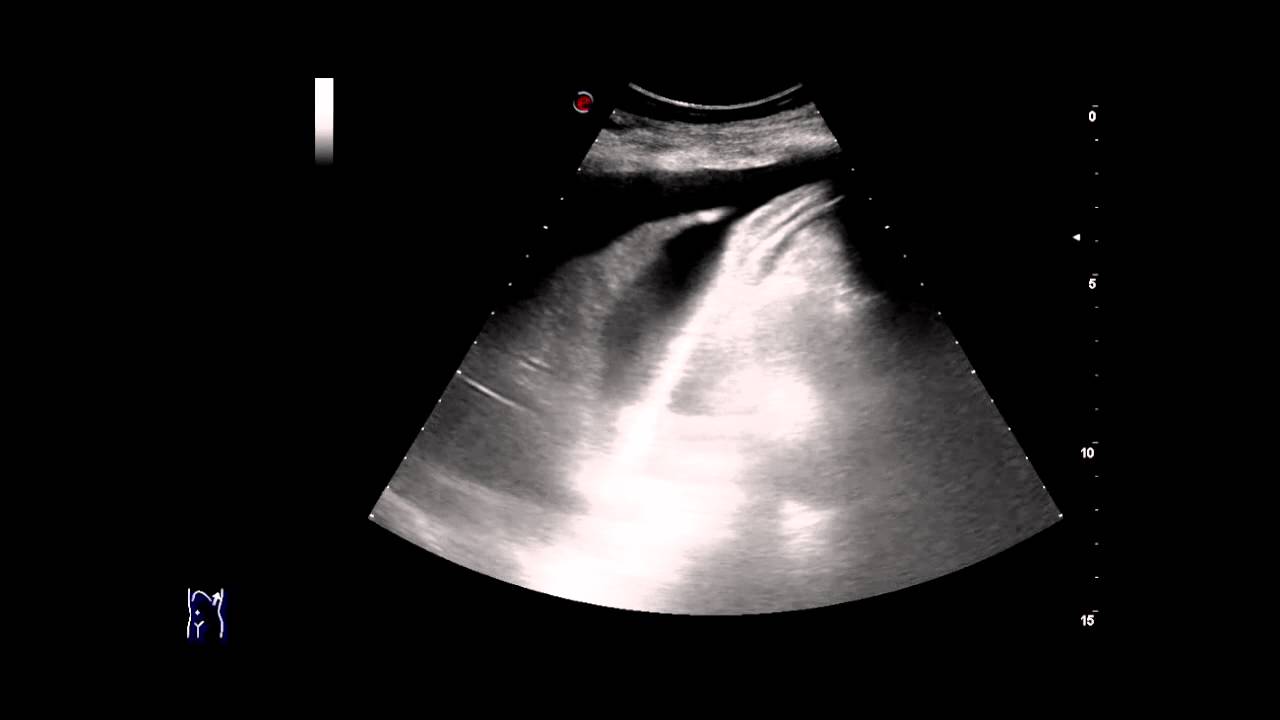 Pleuraerguss mit Atelektase - YouTube