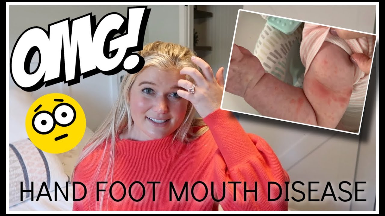 HAND FOOT MOUTH DISEASE BABY AND ADULT | TREATING HFM - YouTube
