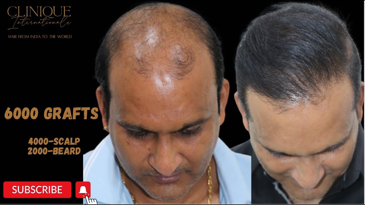 Best Hair Transplant Surgery Results 6000 Grafts 6 Months Before best-hair-transplant-surgery-results-6000-grafts-6-months-before