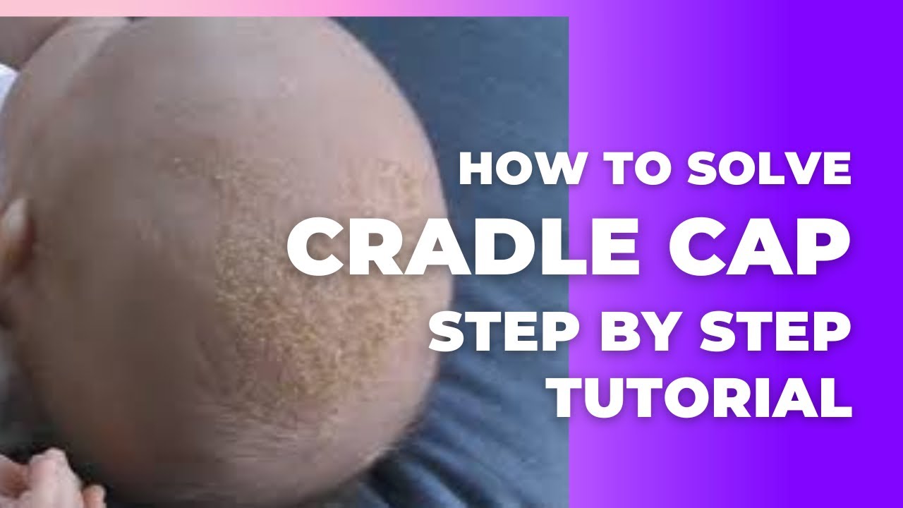 How to Get Rid of Cradle Cap: Step-by-Step Guide - YouTube
