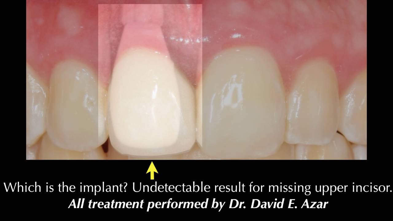 "The Good, The Bad & The Ugly of Dental Implants" - YouTube