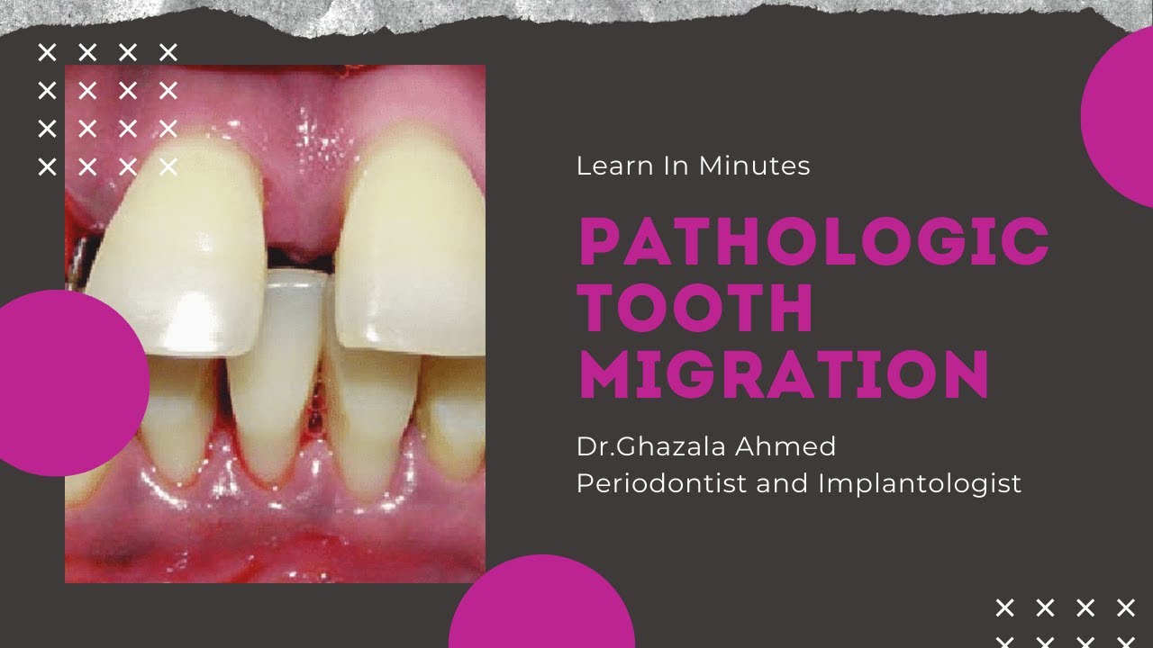 What is Pathologic Tooth Migration? - YouTube