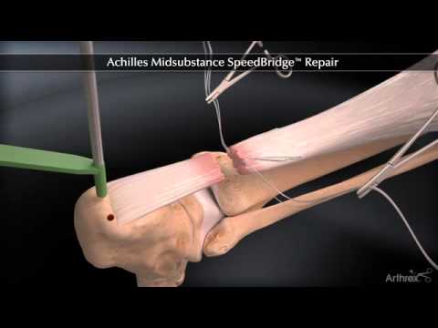 Achilles Midsubstance SpeedBridge™ - YouTube