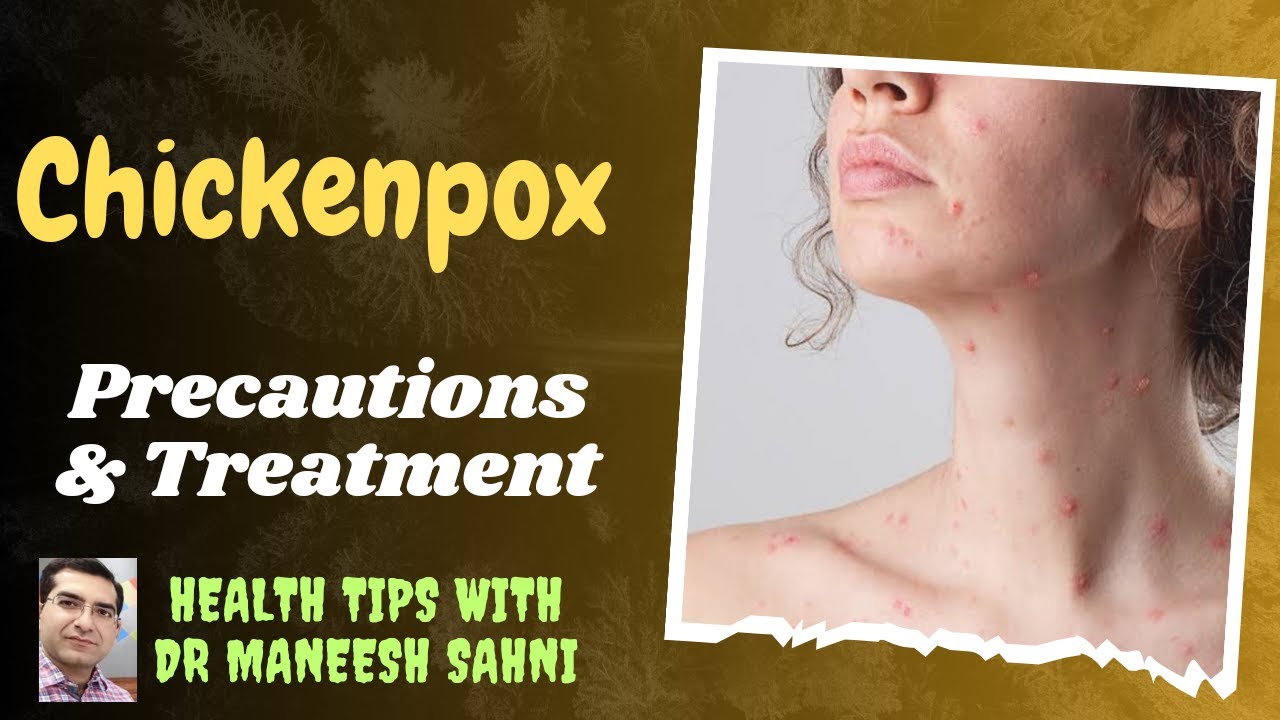 Chickenpox: Precautions & Treatment - YouTube