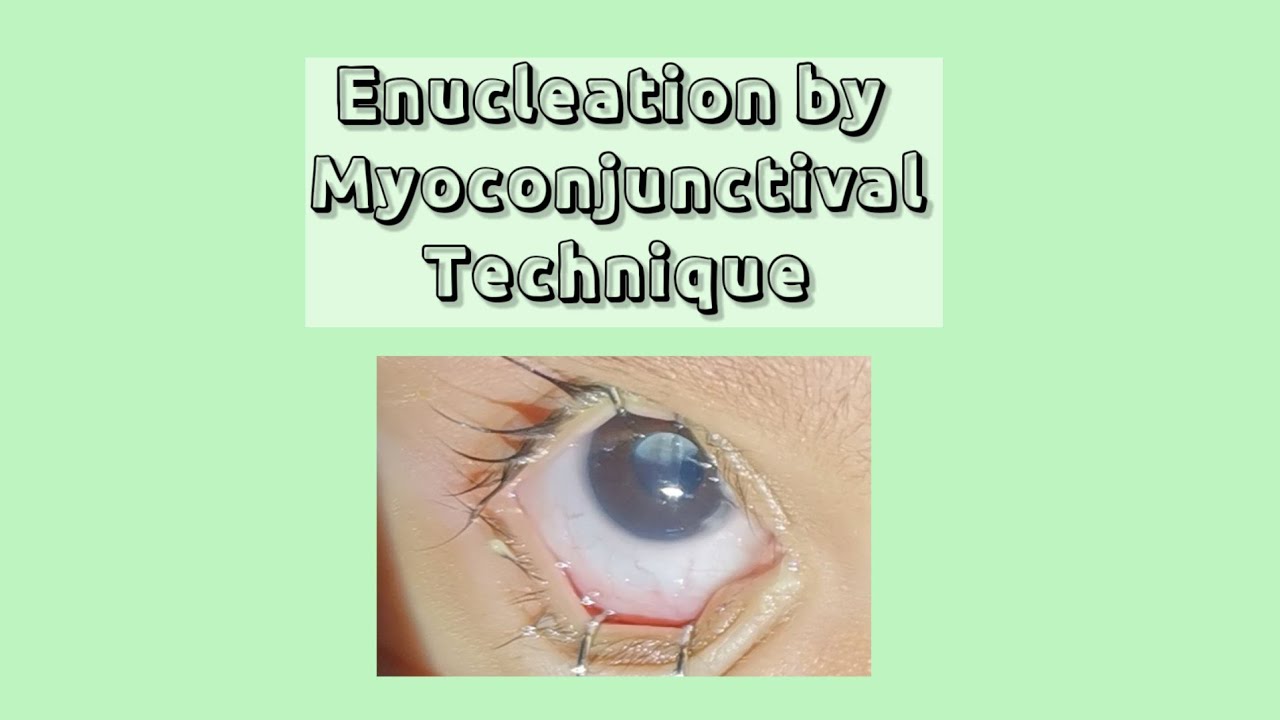 Enucleation by Myoconjunctival technique #eye #ocularoncology # ...