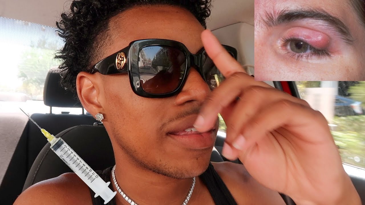 I Finally Got Surgery & Got This Stye Removed (WORST PAIN EVER) - YouTube