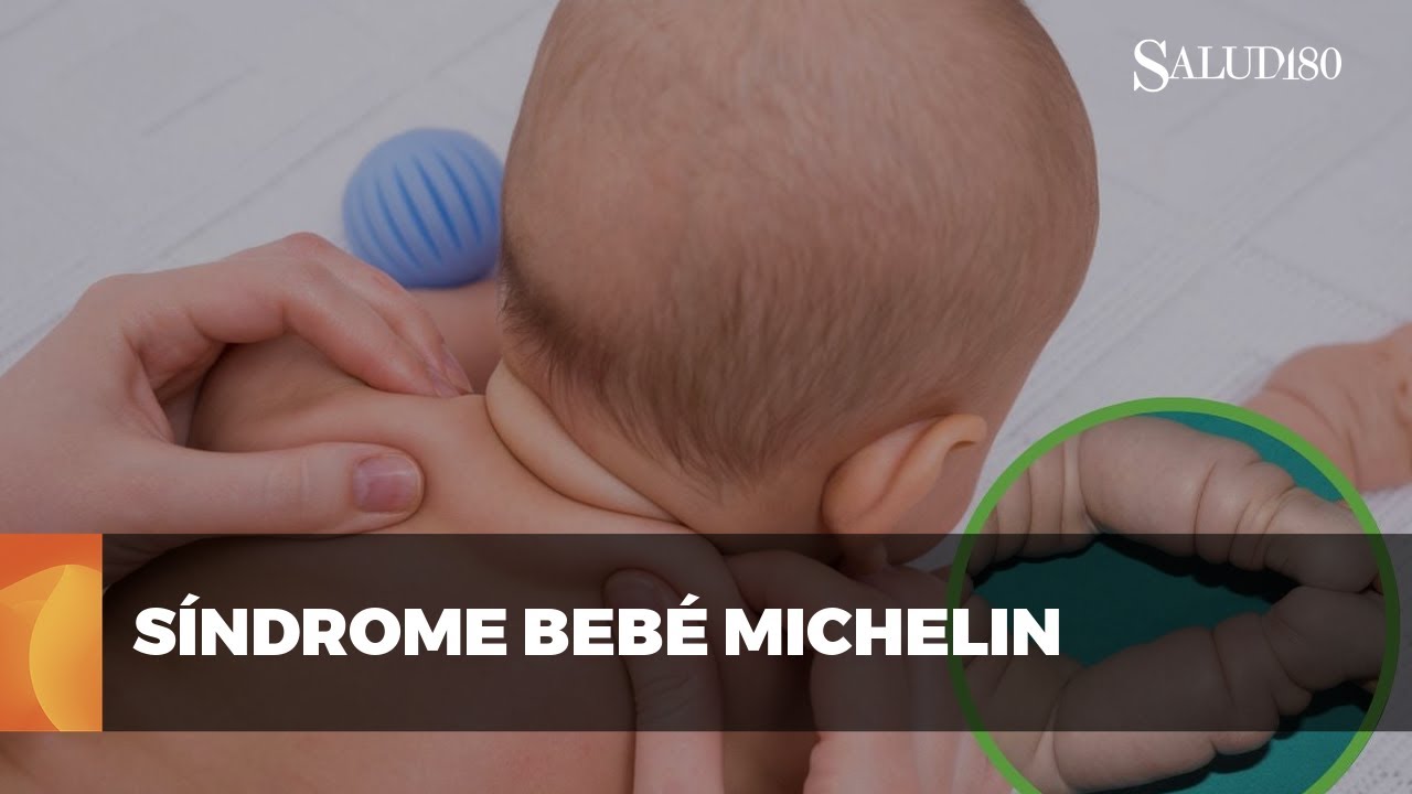 Entendiendo el síndrome del bebé Michelin y su atención | Salud 180 ...