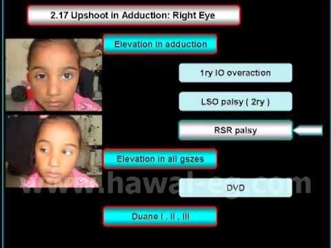 Strabismus: Upshoot in Adduction: Left Eye - YouTube