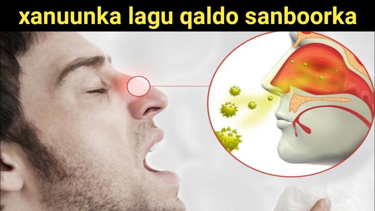 caabuqa ku dhaca sanqada ee lagu qaldo sanboorka #xanuunka - YouTube