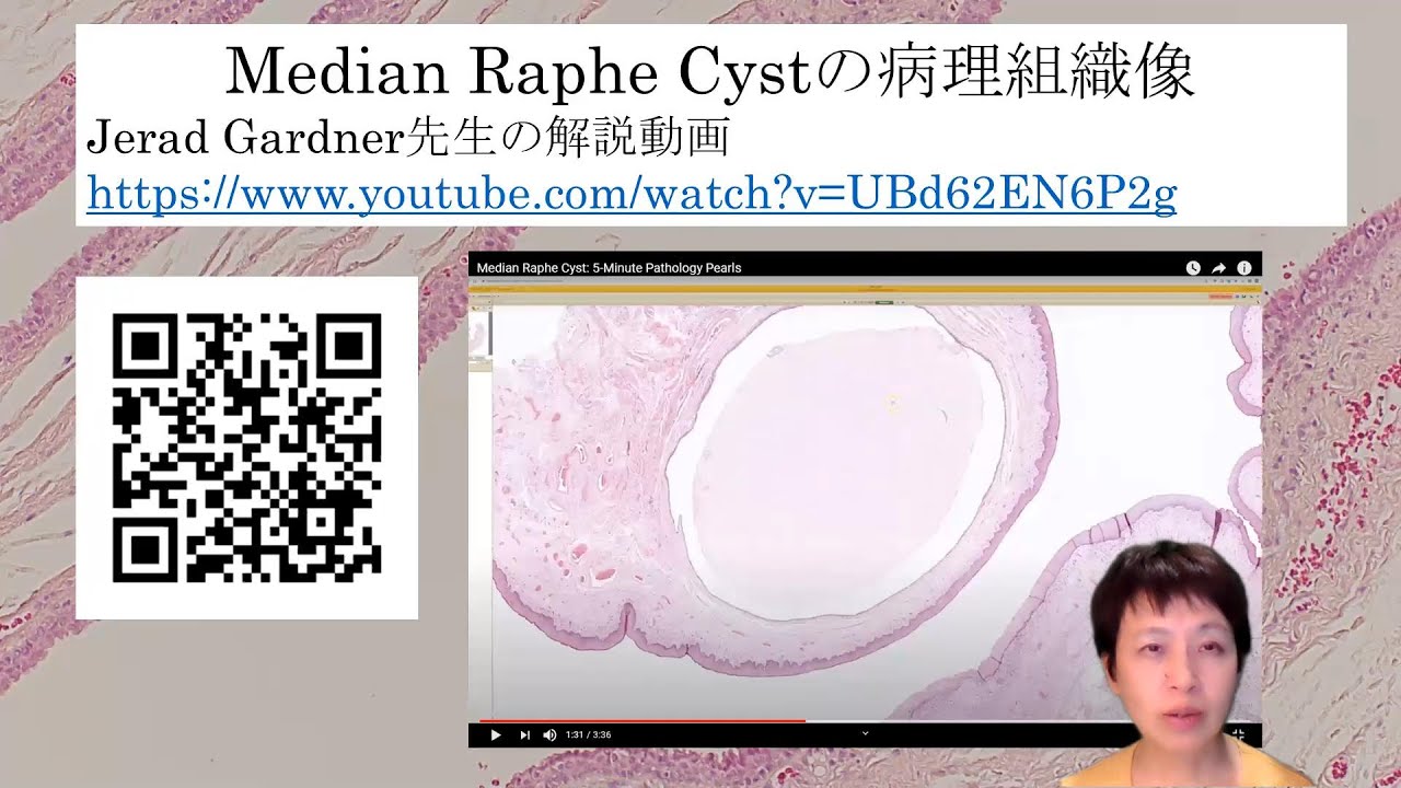 median raphe cyst病理組織像解説 - YouTube
