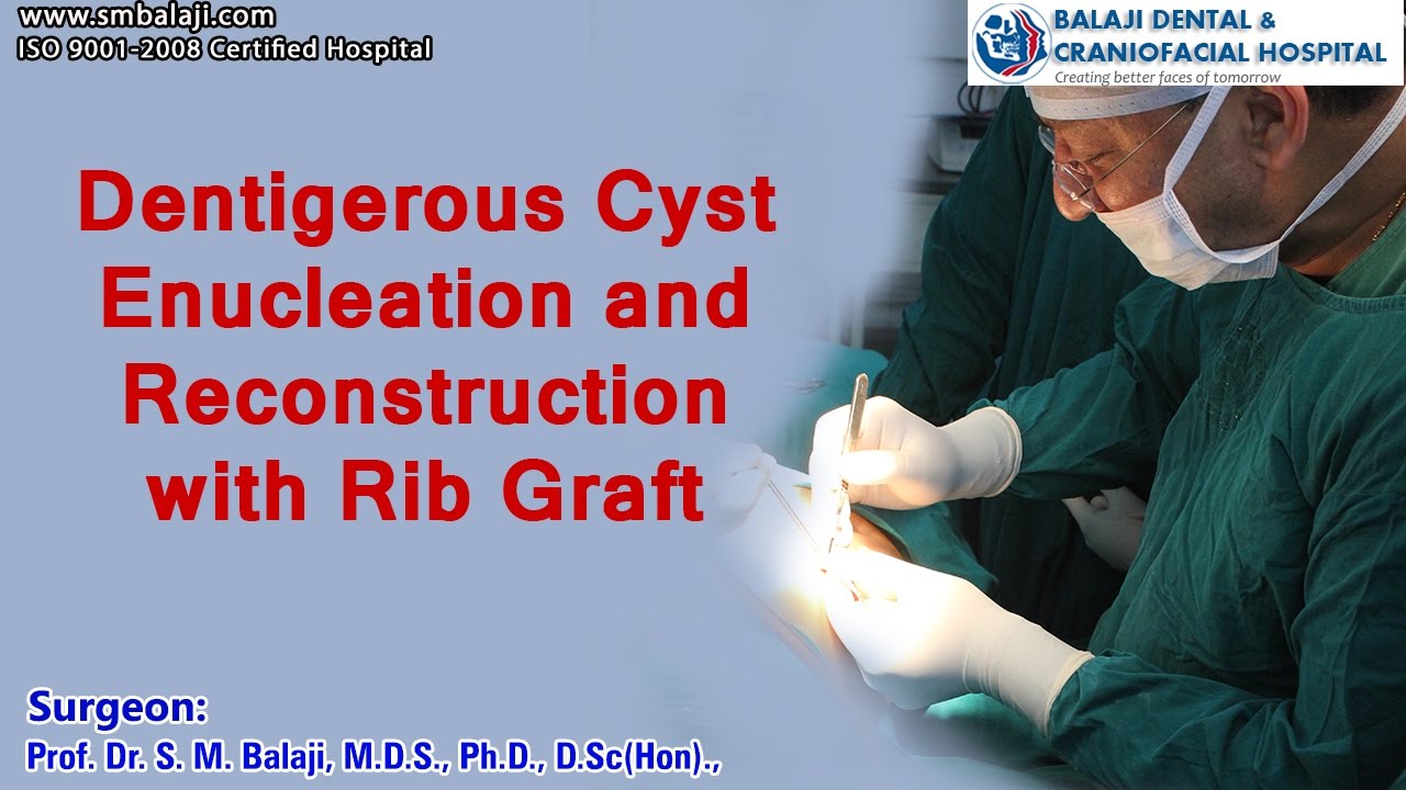 Dentigerous cyst enucleation and reconstruction with rib graft - YouTube