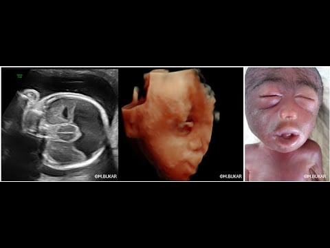 ALOBAR HOLOPROSENCEPHALY WITH CEBOCEPHALY - YouTube