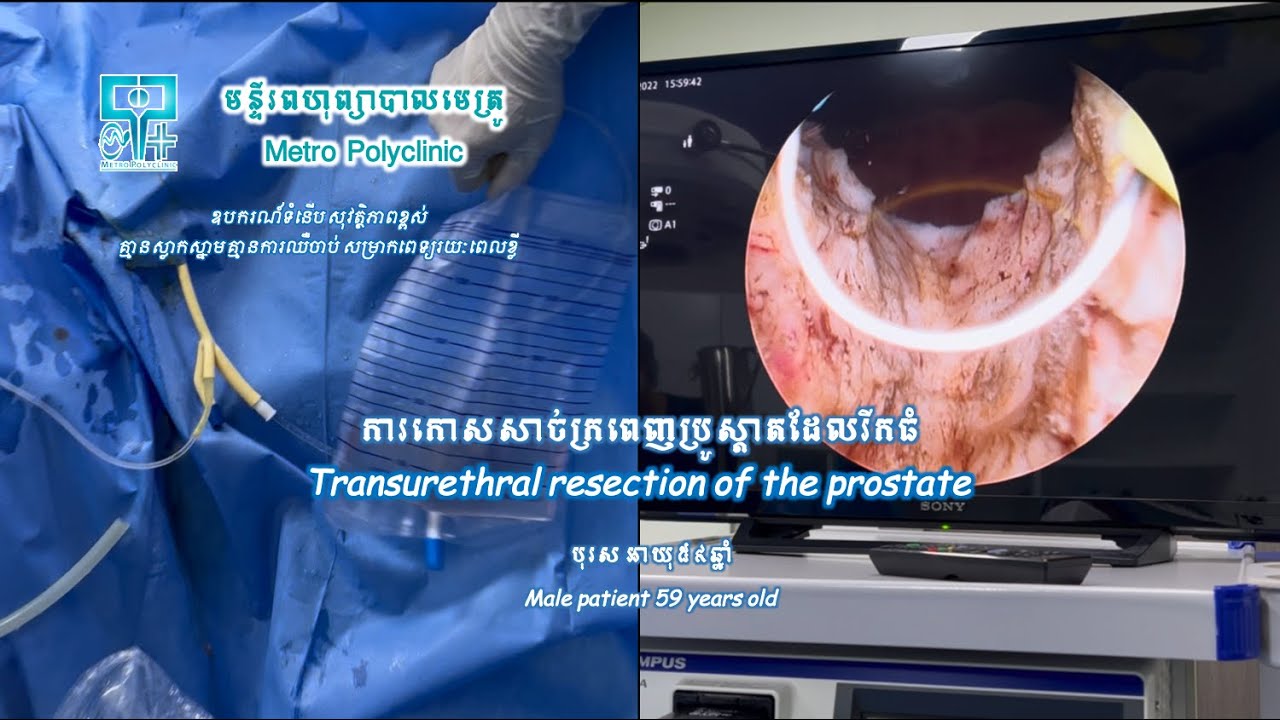 ការកោសសាច់ក្រពេញប្រូស្តាតដែលរីកធំ លើបុរស អាយុ59ឆ្នាំ ដែលពិបាកបត់ជើងតូច ...