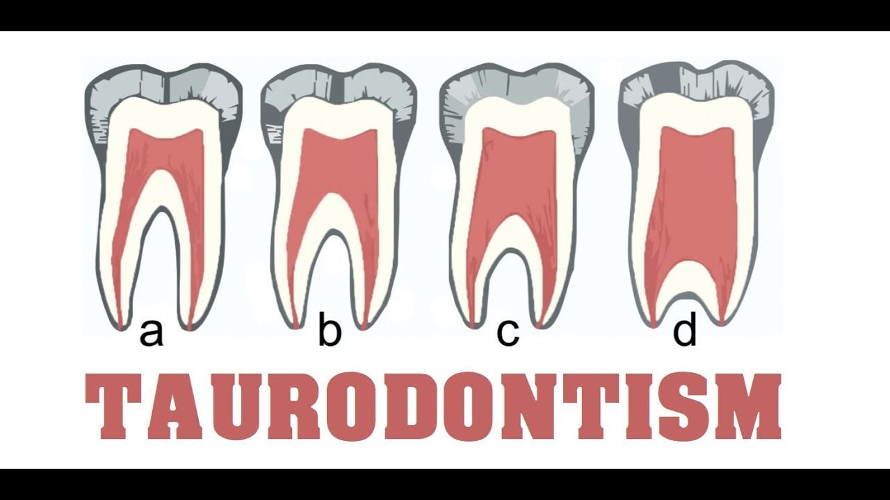 What is Taurodontism? - YouTube