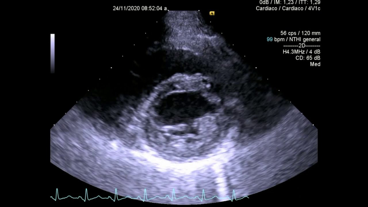Tetralogia de Fallot operada - YouTube
