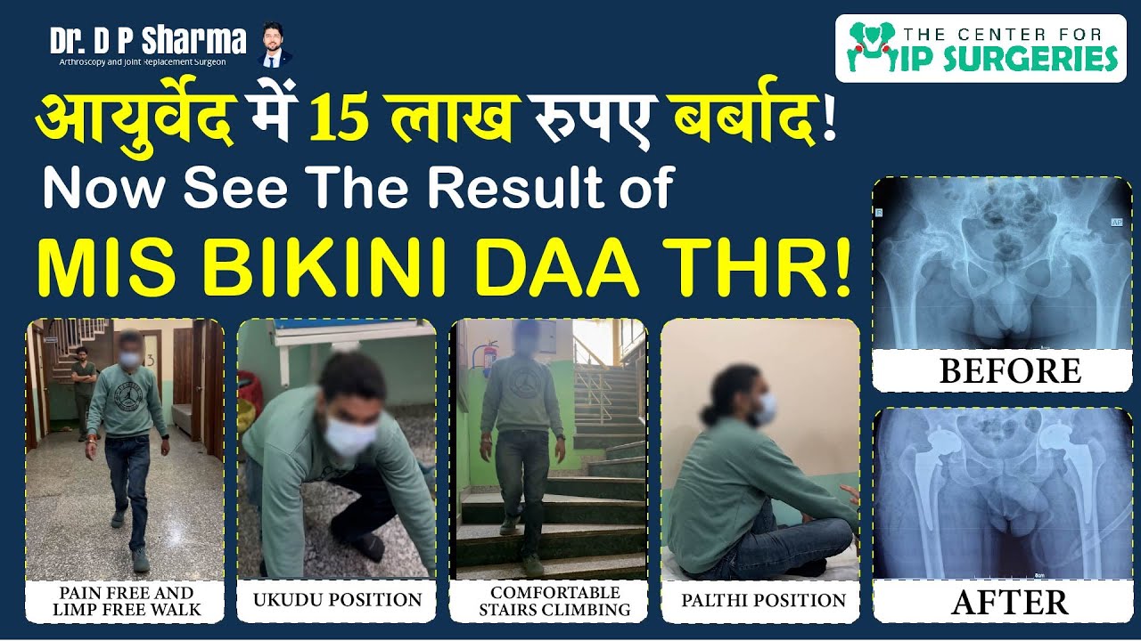 Bilateral MIS BIKINI DAA Total Hip Replacement of a Patient From Delhi ...