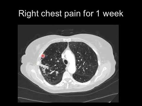 Collapse Vs Consolidation at CT Scanning part IV - YouTube