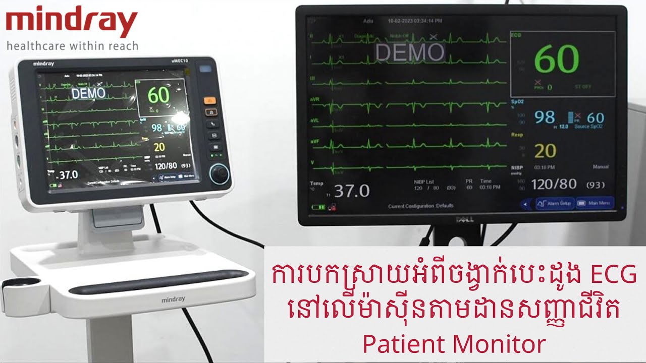 ECG Interpretation Method On Mindray UMEC10 Patient Monitor YouTube ECG Interpretation Method On Mindray UMEC10 Patient Monitor YouTube