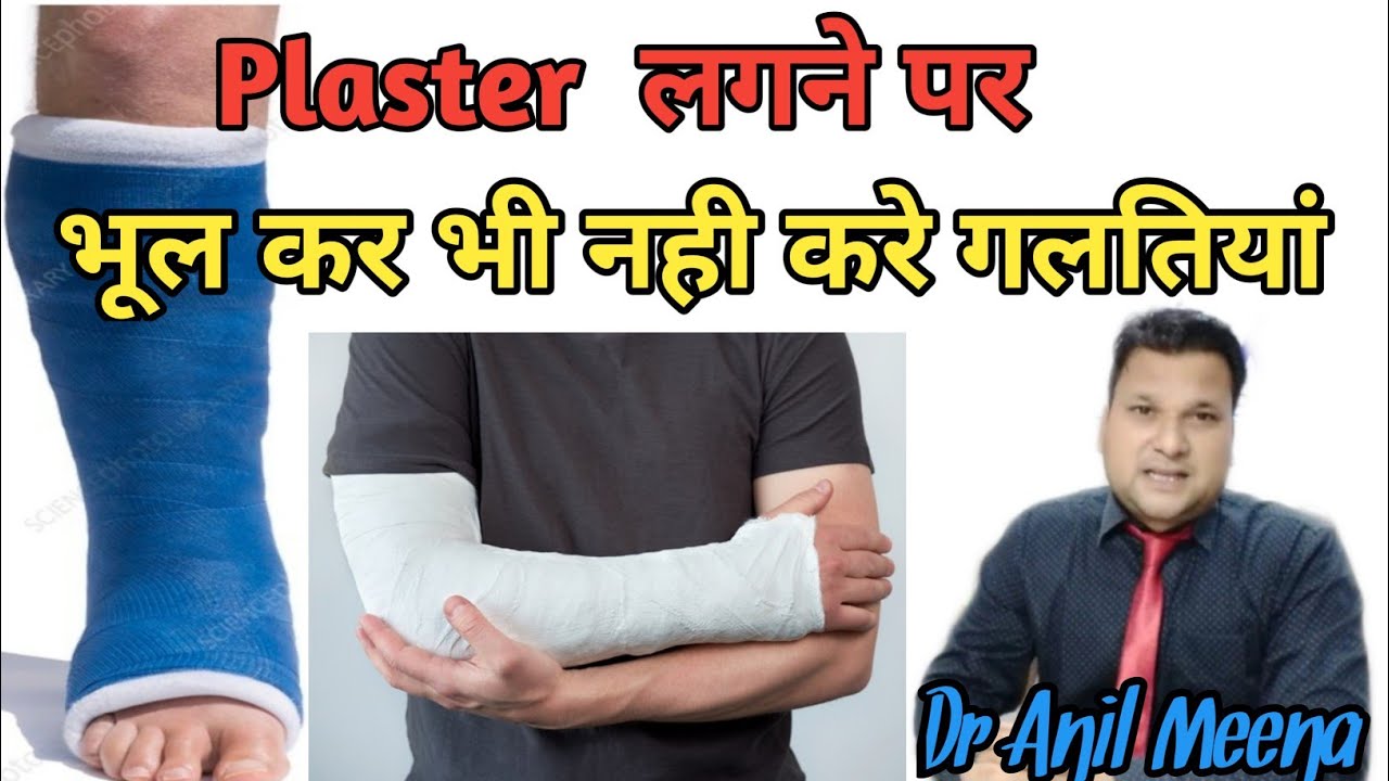 Precautions after plaster cast | plaster lagne par savdhaniya | Plaster ...