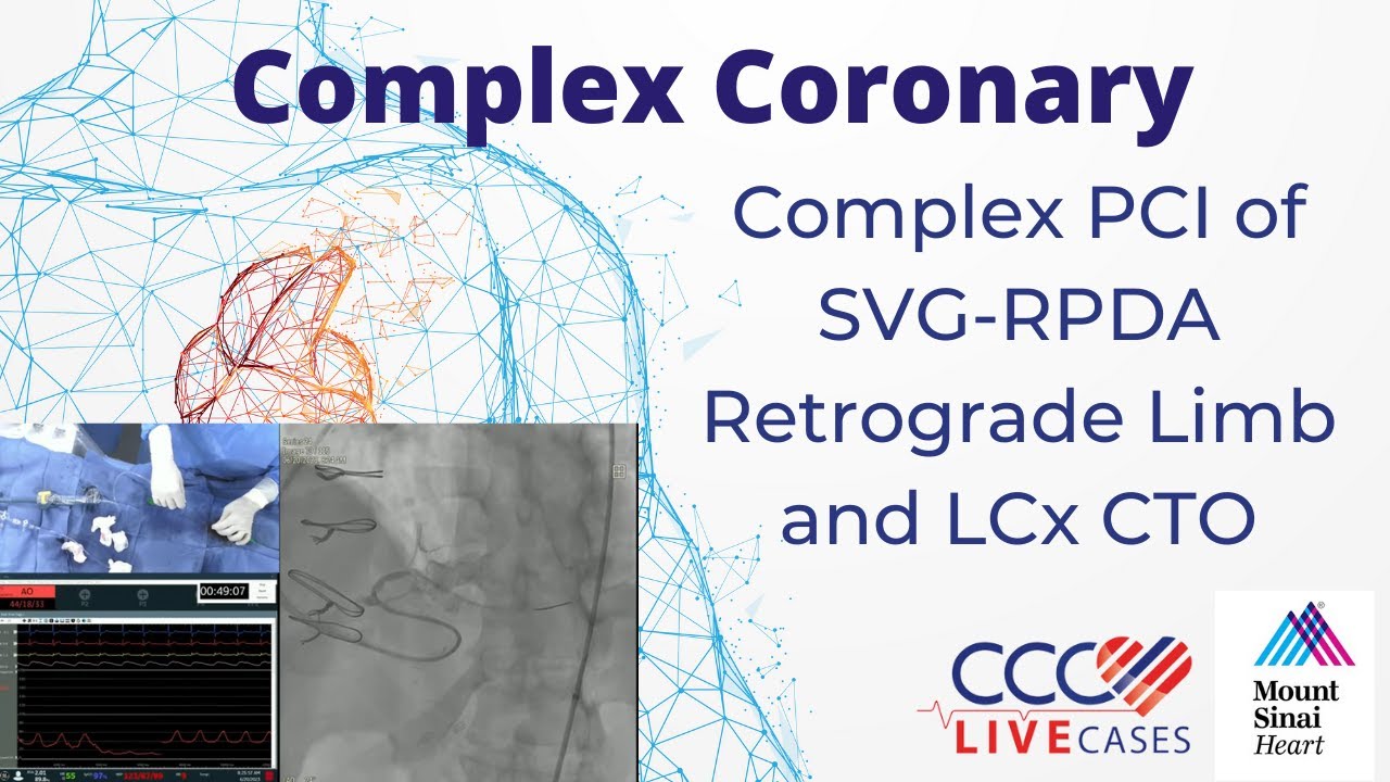 Complex PCI of SVG-RPDA Retrograde Limb and LCx CTO - YouTube